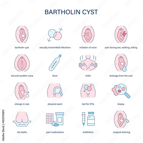 Bartholin Cyst Symptoms Diagnostic And Treatment Vector Icons Medical