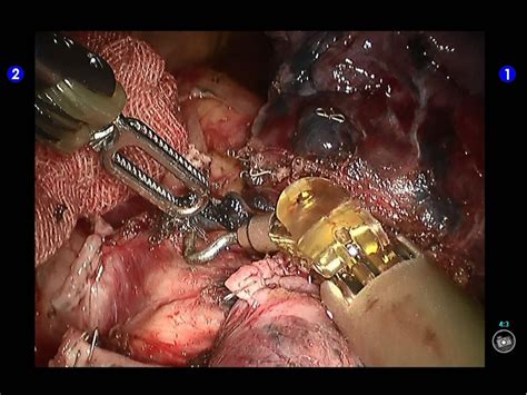 Robotic Assisted Left Upper Lobectomy Pmc