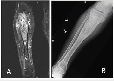 Mri A And Radiograph B Of The Tibia Mri Magnetic Resonance Imaging Download Scientific