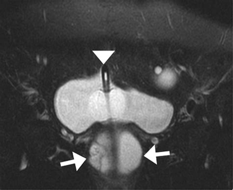 Urethral Diverticulum Diagnosis With Virtual Ct Urethroscopy Ajr