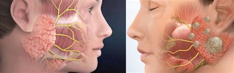 Parotid Gland Tumor Benign