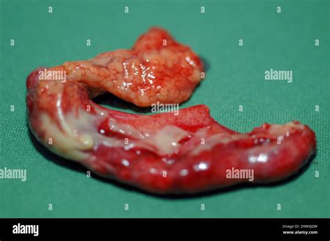 The Excised Appendix It Is Larger Than It Would Appear In A Normal Specimen Due To It Being