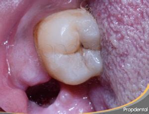 Tratamiento Alveolitis Seca Dolor Después De La Extracción Dental