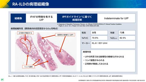 病理組織像から考えるctd Ildの病態と線維化に対する治療介入（静止画）