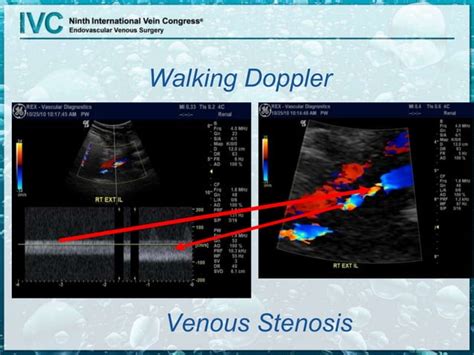 Detecting Deep Venous Disease With Duplex Ultrasound Pdf Medical Health