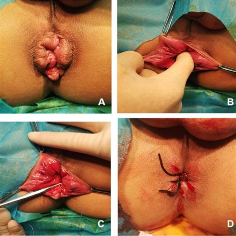 A The Patient Was Placed In The Lithotomy Position And The