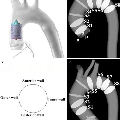 Post Lvad Implantation M Mode Echocardiogram Of The Aortic Valve And