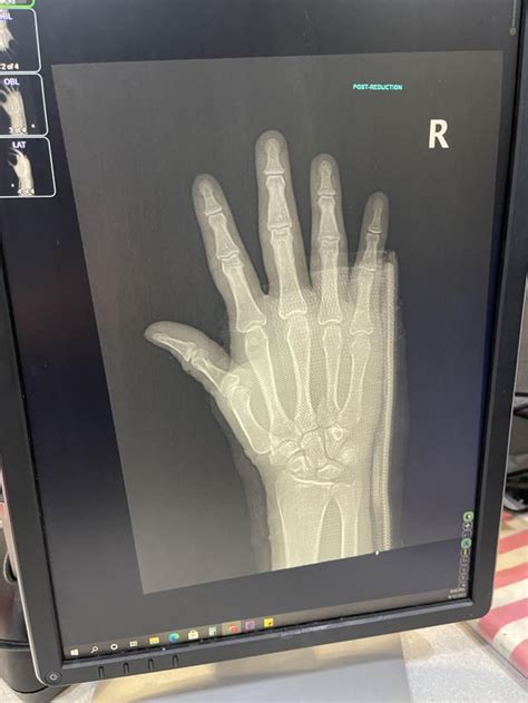 I Broke My 4th Metacarpal And Dislocated My 5th One Rxrayporn