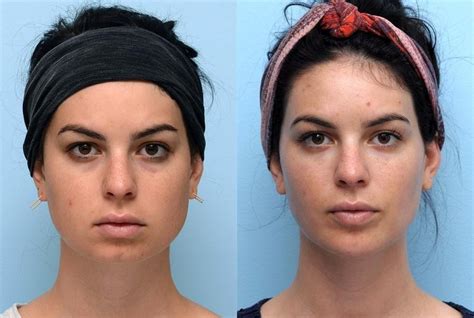 Masseter Botox Phx Suddenly Slimmer Med Spa Phoenix