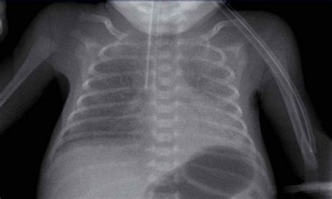 Bronchopneumonia X Ray Pediatric
