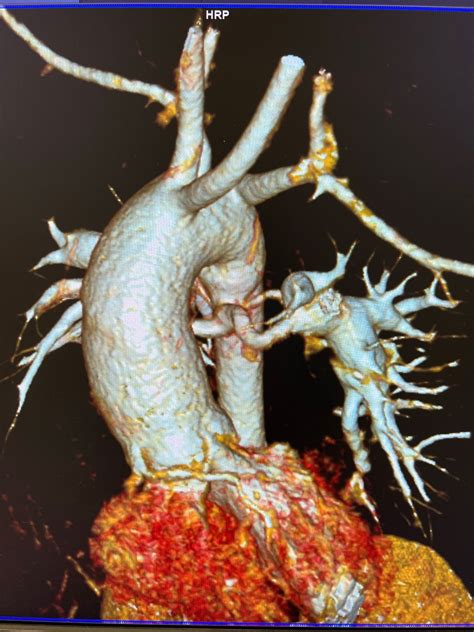 Tarek Salama On Linkedin Tof Total Pulmonary Atresia With Mapcas Dependent Pulmonary Circulation…
