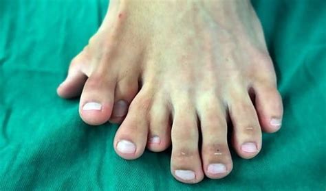 This 21 Year Old Man Was Born With 9 Toes The Four On The Right Were