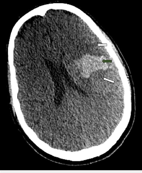 Cerebral Ct Axial Slice Without Injection Of Contrast Left Deep
