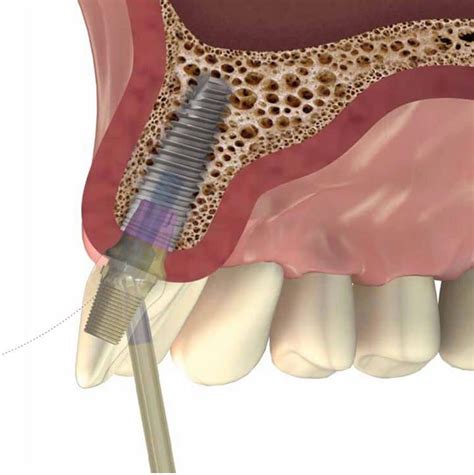 Ez Base By Mis Mis Implants Serbia