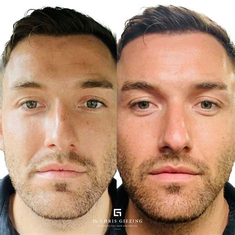 Chris Giezing On Linkedin Brotox Fillers Aesthetictreatments