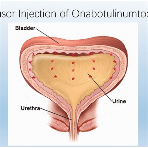 Distribution Of The Injection Points Of Botulinum Toxin A Download