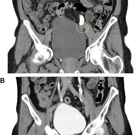 A B Ct Ivp Before The Surgical Excision And 6 Month Post Operation