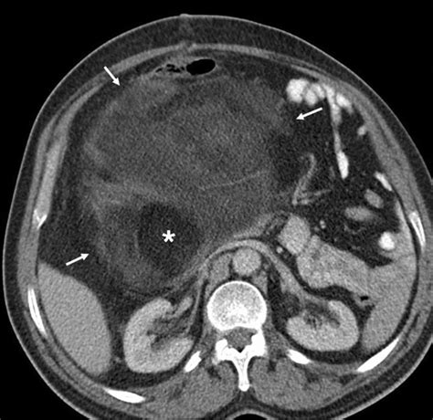 Mesenteric Liposarcoma A 58 Year Old Male With A Newly Detected