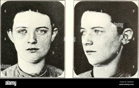 Lobotomy Before And After