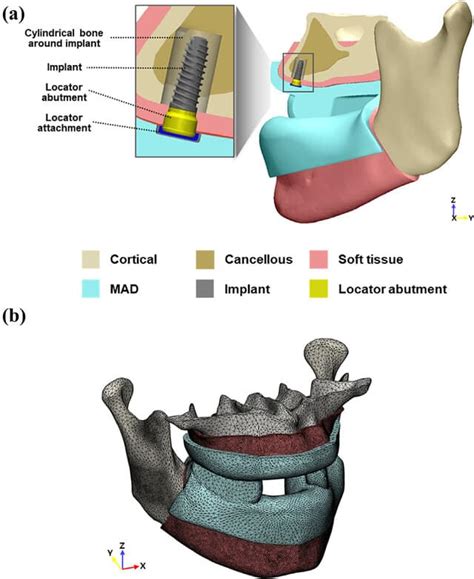 Mandibular Advancement Devices With Dental Implants For Obstructive