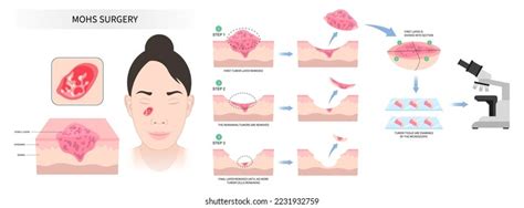 Facial Mohs Surgery Basal Cell Microscopic Stock Vector Royalty Free