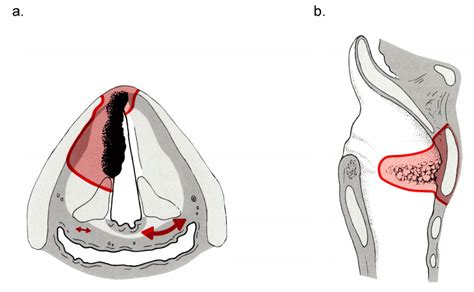 A And B Indications And Surgical Margins Of Frontolateral Partial Download Scientific