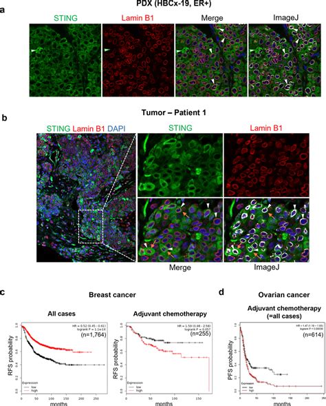 Clinical Relevance Of Sting In Breast Cancer A Immunofluorescence Of