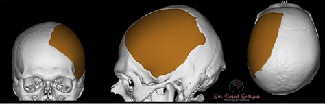 Reconstrução Do Crânio Cranioplastia Dra Raquel Rodrigues