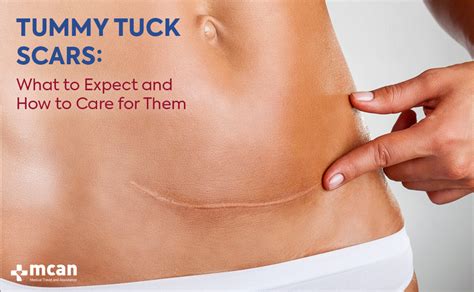 Tummy Tuck Scars What To Expect And How To Care For Them Mcan Health