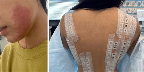 Heres What Getting A Skin Patch Test Is Really Like Self