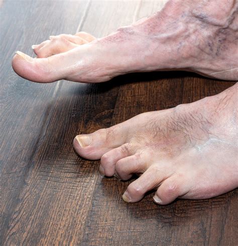 Toe Deformities Zerosole