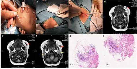A Clinical Manifestations Consisted Of A Fistula Located In The Oral