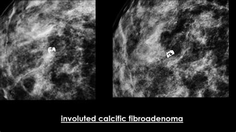 Breast Fibroadenoma Imaging Pptx