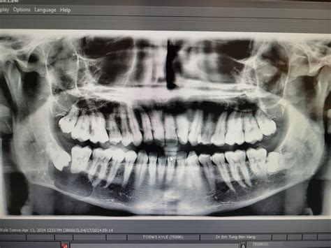 Cyst Under Impacted Wisdom Tooth Roralsurgery