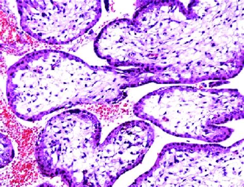 This Is The Histopathological Report Showing Chorionic Villi With Download Scientific Diagram