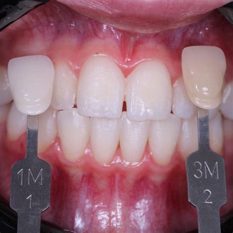 Dental Bleaching The Science Based Techniques For Every Day — Explore