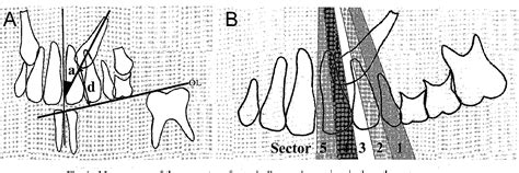 Figure 1 From Severe Cases Of Ectopically Erupting Maxillary Canine