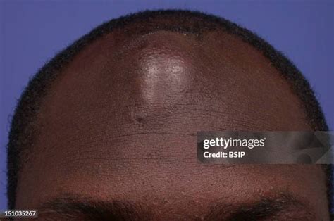 Skin Abscess Photos And Premium High Res Pictures Getty Images