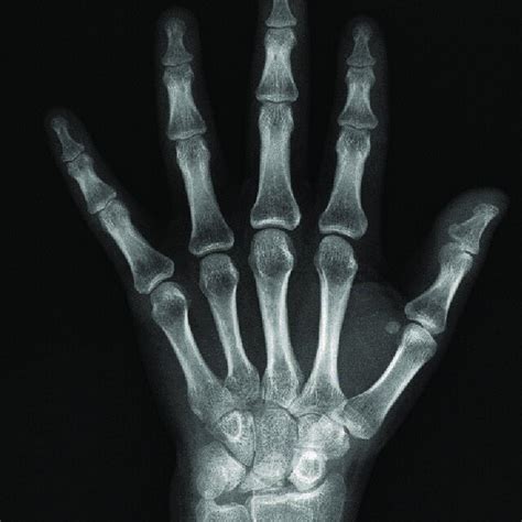 Kienbock S Disease Stage 3b The Collapse Of Lunate Fixed Scaphoid