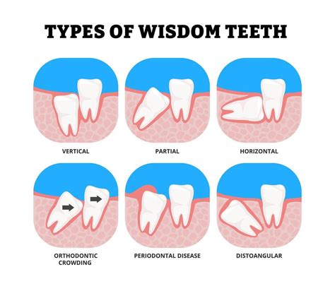 Different Types Of Wisdom Teeth Types Set Collection Labeled