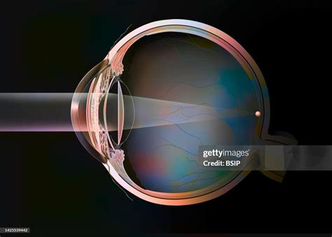 Intra Ocular Implant High Res Vector Graphic Getty Images