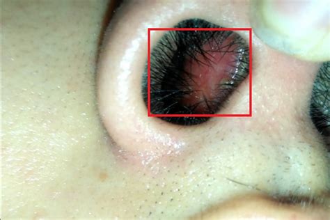 鼻腔内侧有一个凸起物图片