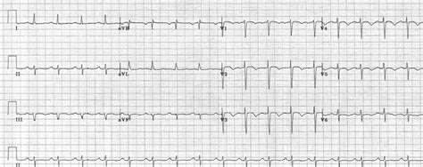Ecg Practice Interpretation Practice Ekg Tests And Ekg Strips