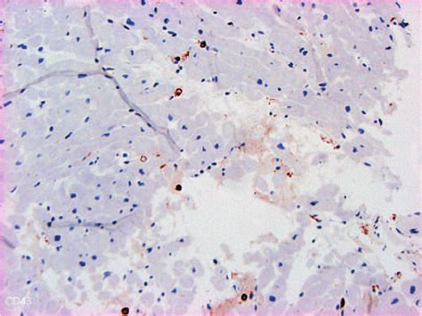 Immunohistochemical Staining For Cd43 T Lymphocytes Confirms The