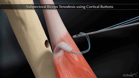 Torn Bicep Tendon Rehab