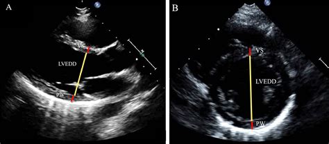 Comparison Of Left Ventricular Mass Calculation Methods Via Two