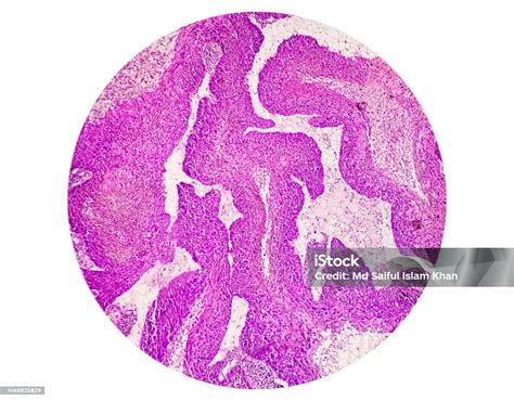 Photomicrograph Showing Tongue Squamous Cell Carcinoma Grade Ii Oral
