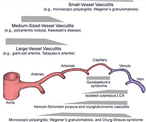 Small Vasculitis Cutaneous Small Vessel Vasculitis Comprehensive