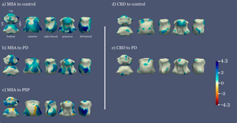 Midbrain And Pons Mri Shape Analysis And Its Clinical And Csf