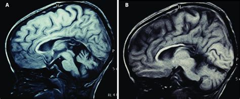 A And B Sagittal T1 Weighted Mri Showing Normal Rostrum Genu And Body